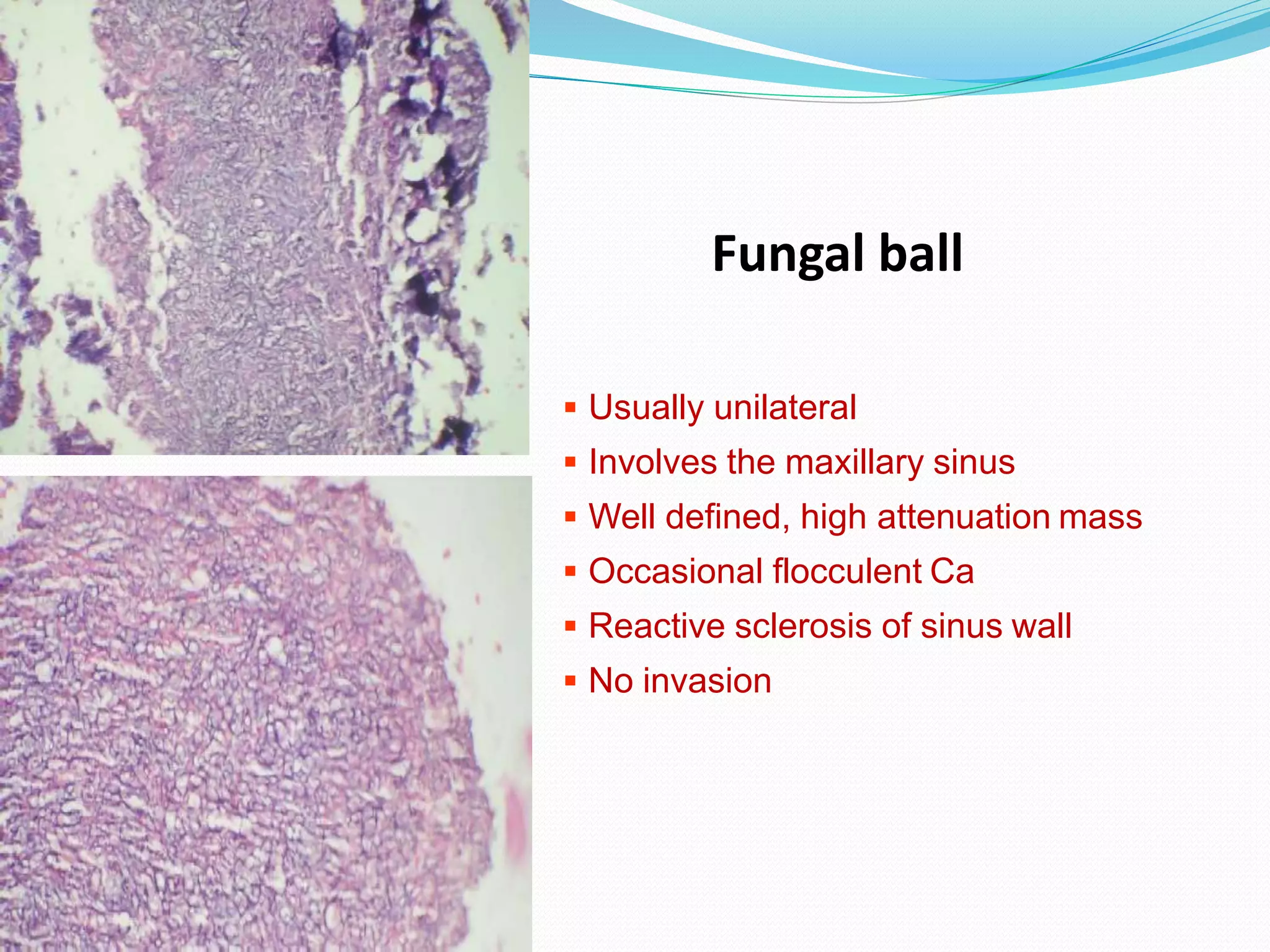 Fungal Rhinosinusitis | PPT