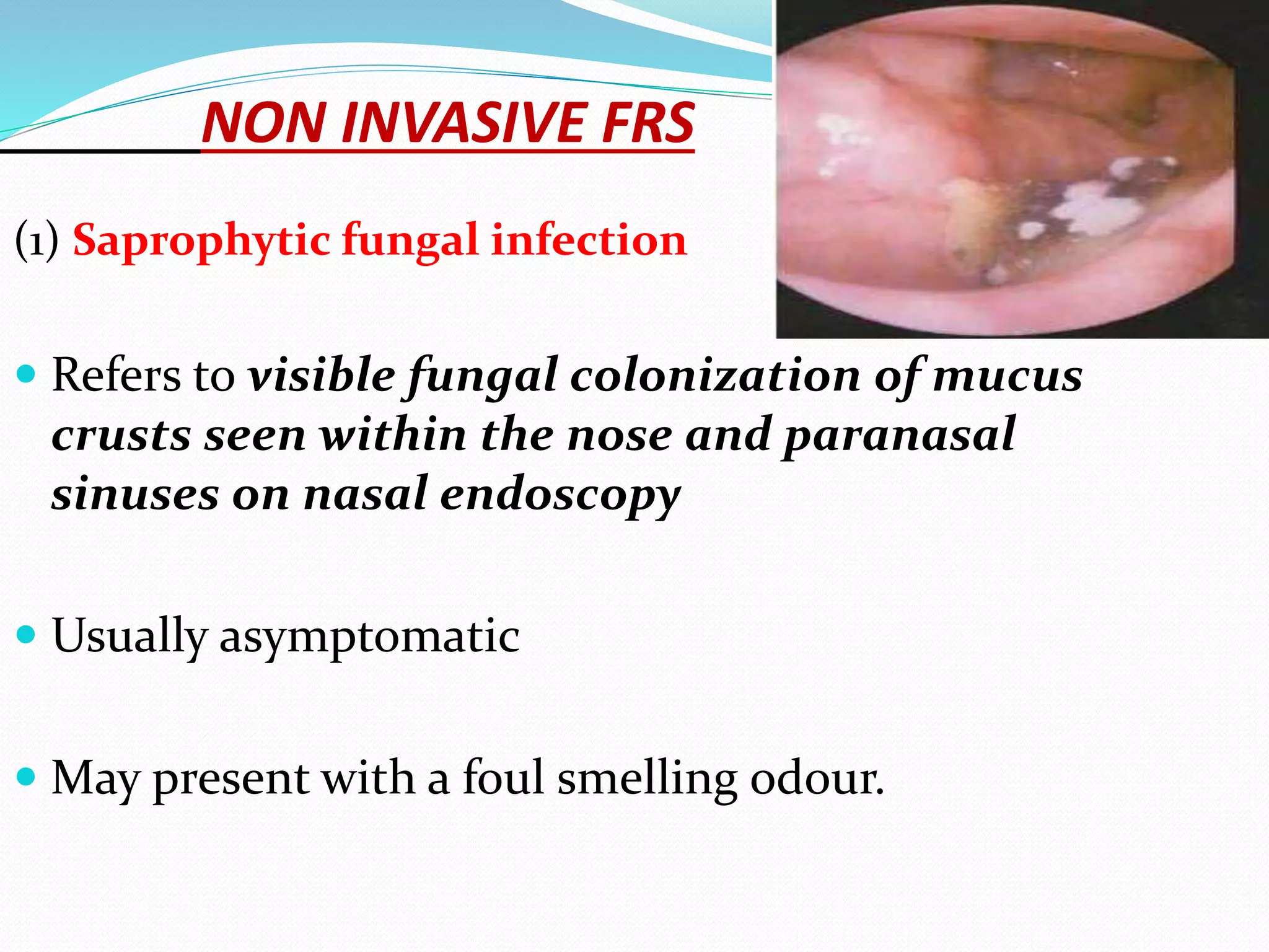 Fungal Rhinosinusitis | PPT