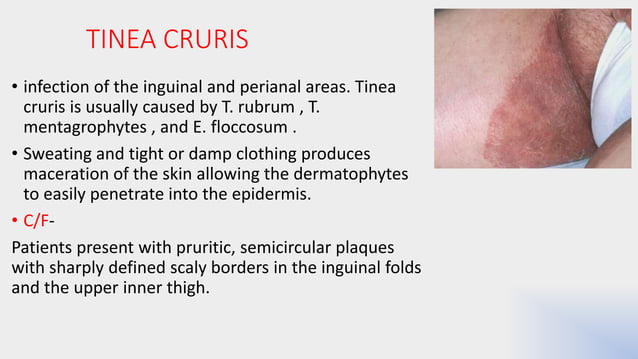 Fungal skin infection.pptx