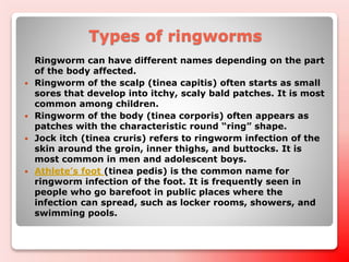 Fungal skin infection (ringworm) | PPTX