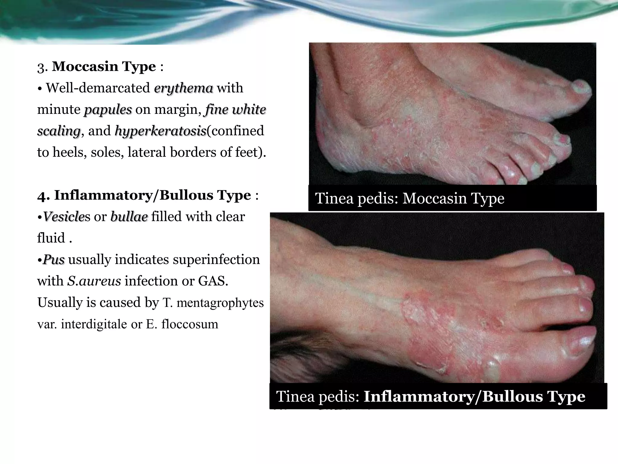 Fungal skin infection | PPTX
