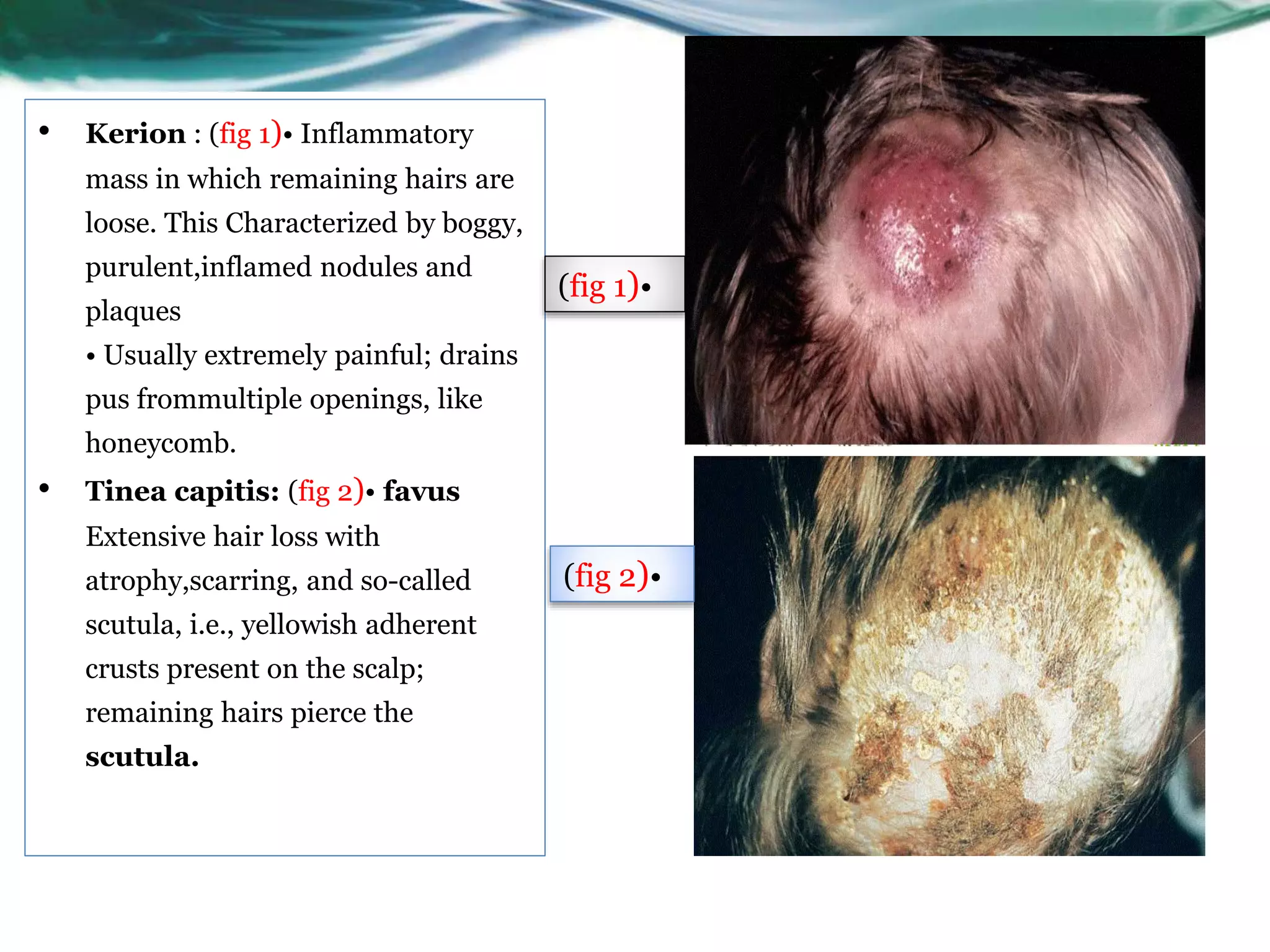 Fungal skin infection | PPTX