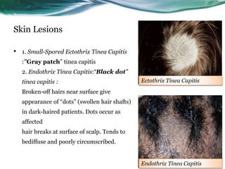 Fungal skin infection | PPTX
