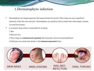 Fungal skin infection | PPT