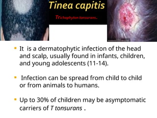 Detailed notes on Fungal Skin Infections.ppt