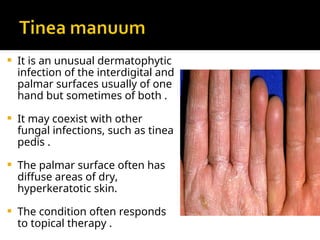 Detailed notes on Fungal Skin Infections.ppt