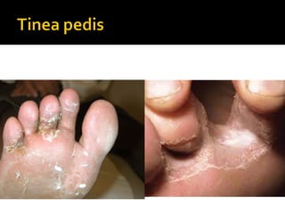 Detailed notes on Fungal Skin Infections.ppt