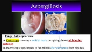 Fungal Urinary Tract Infections by YF.pdf