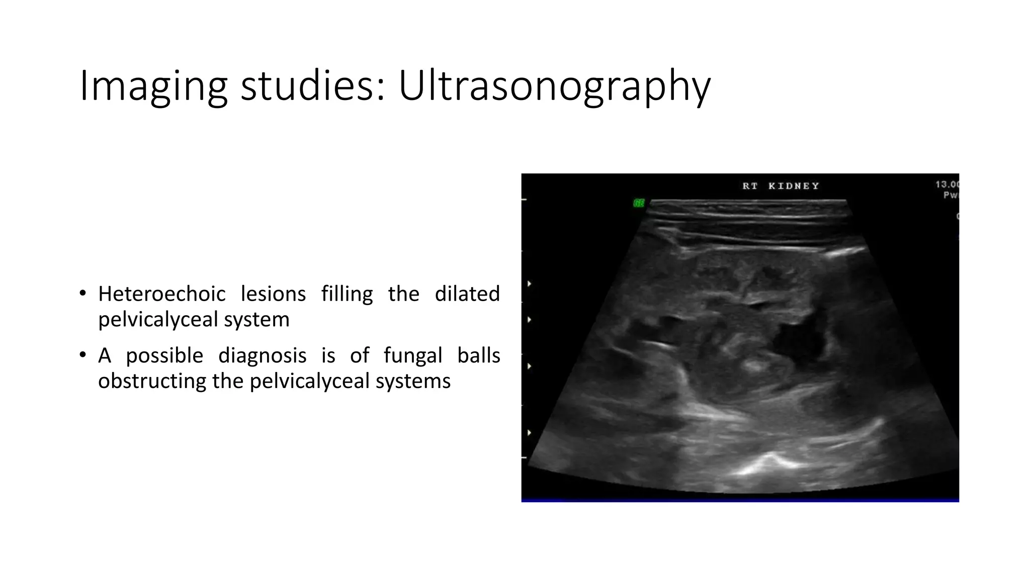Fungal Infections of the Urinary Tract | PPTX