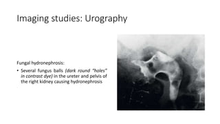 Fungal Infections of the Urinary Tract | PPTX