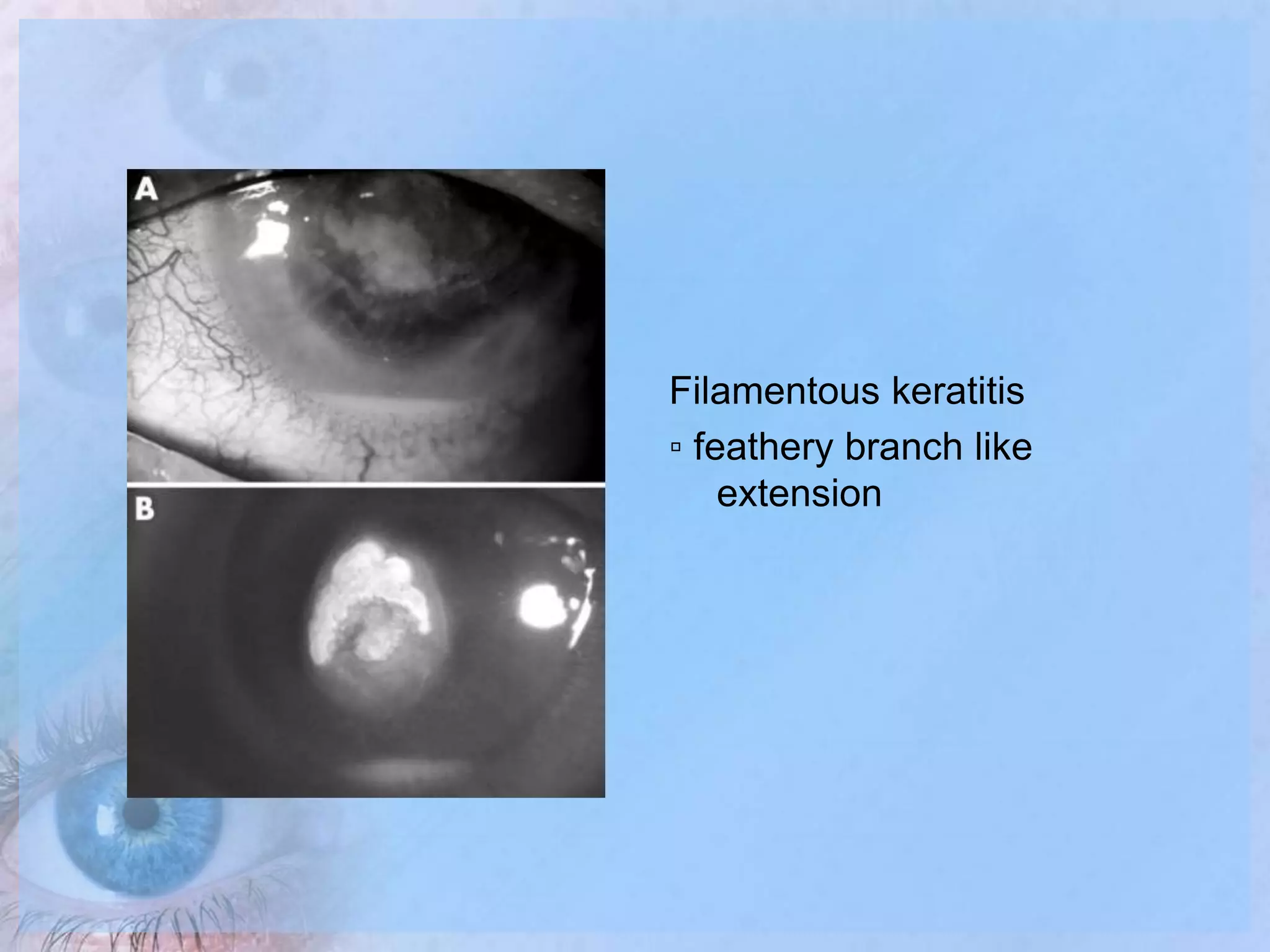 Fungal & viral keratitis | PPTX