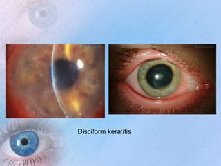 Fungal & viral keratitis | PPTX