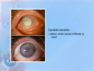 Fungal & viral keratitis | PPTX