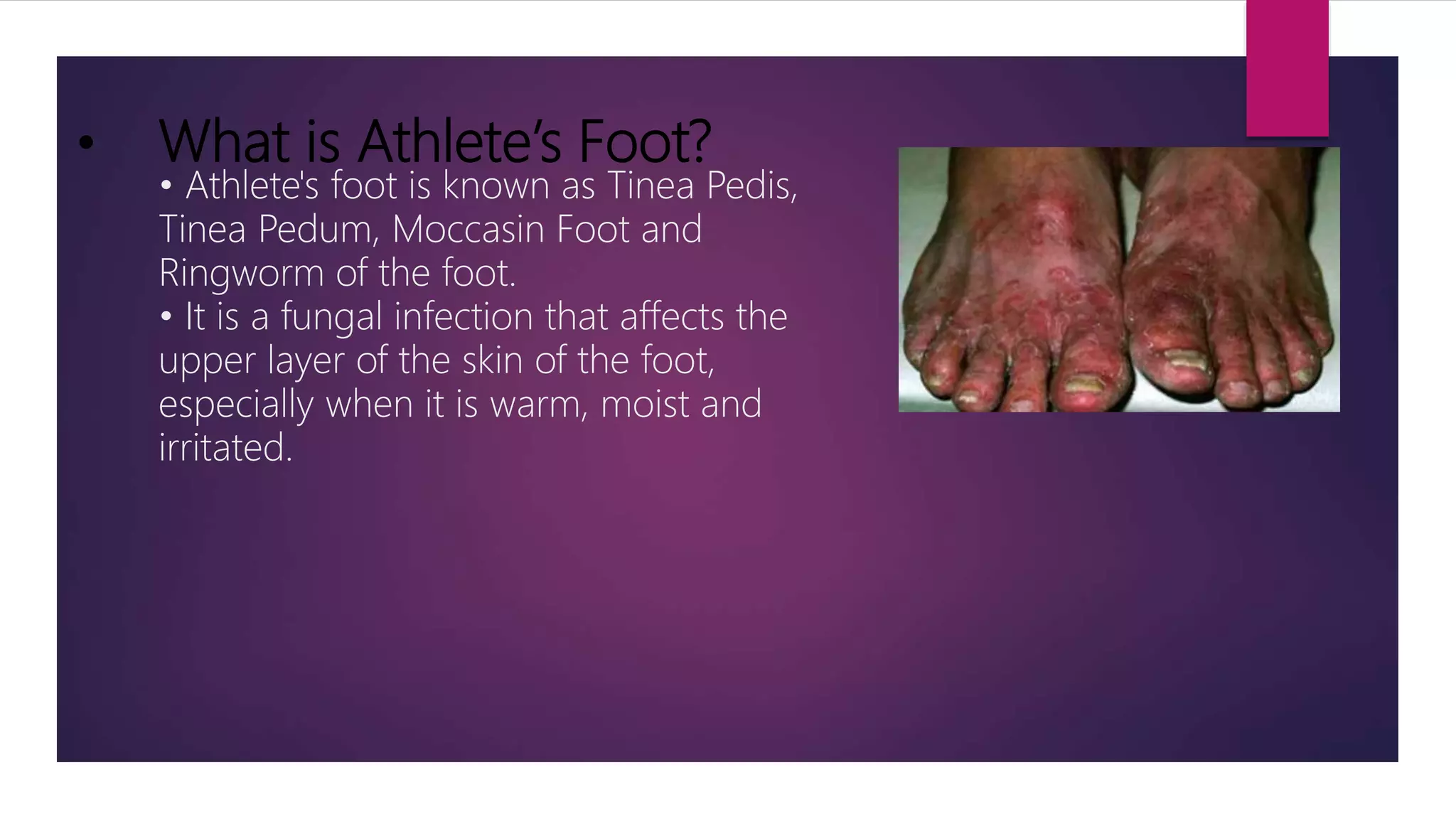 Tinea Pedis Physical Exam Description