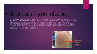 ATHLETE'S FOOT [TENEA PEDIS] FUNGI | PPTX