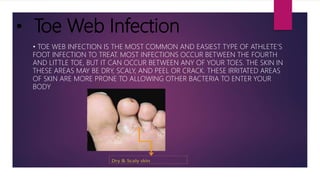 ATHLETE'S FOOT [TENEA PEDIS] FUNGI | PPTX
