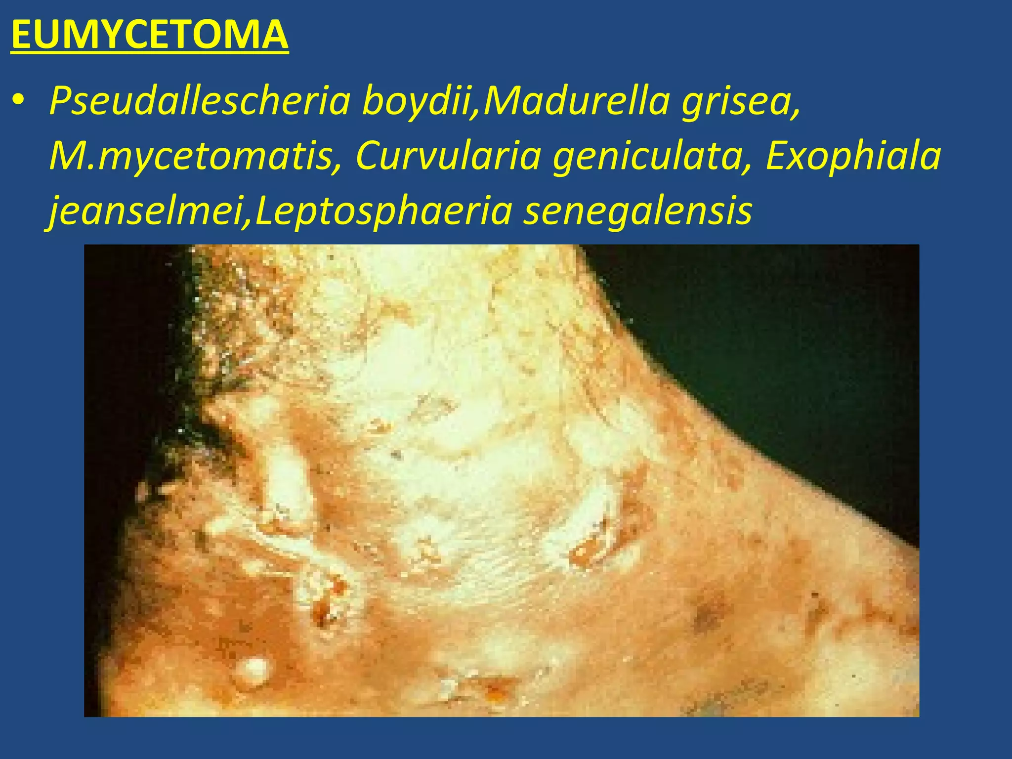 Fungi in tissue sections | PPT