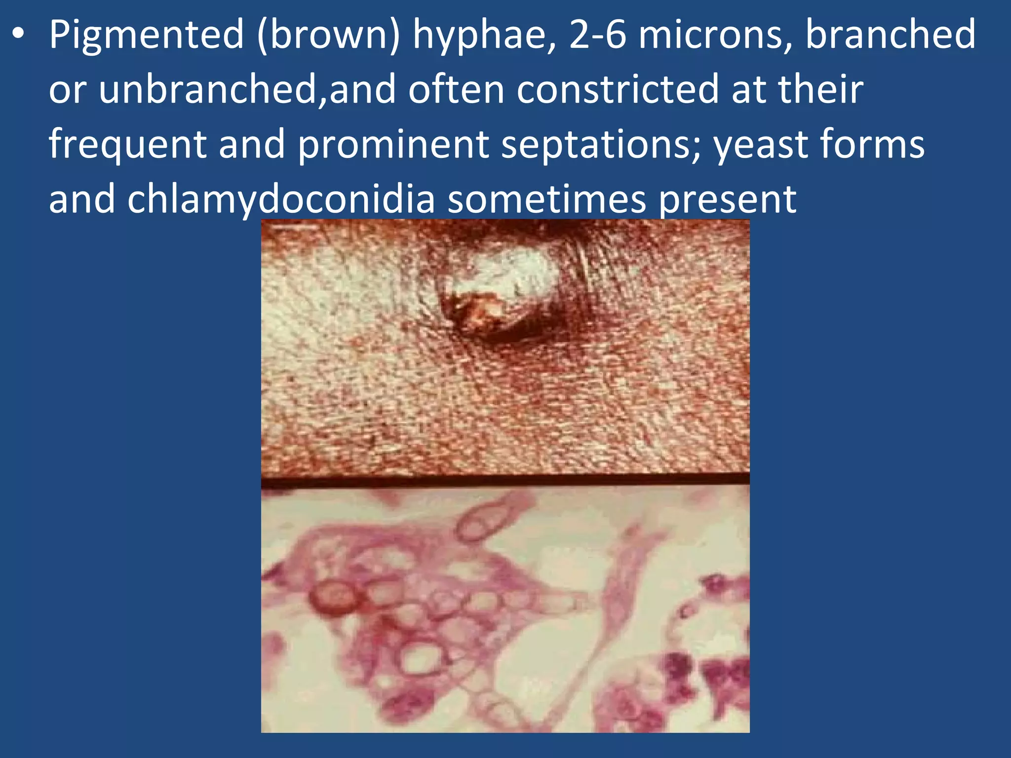 Fungi in tissue sections | PPT
