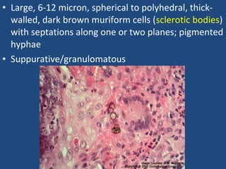 Fungi in tissue sections | PPT