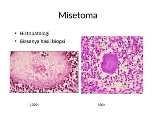 Fungi penyebab penyakit misetoma pada manusia | PPT