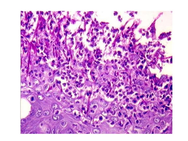 Fungus in histopathology | PPTX | Lung and Respiratory Health ...