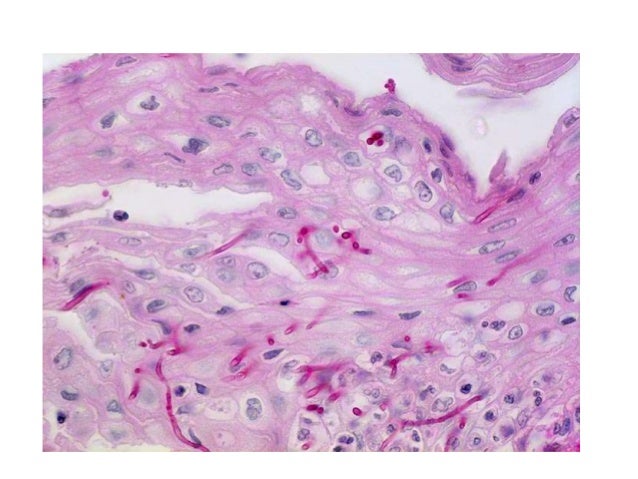 Fungus in histopathology