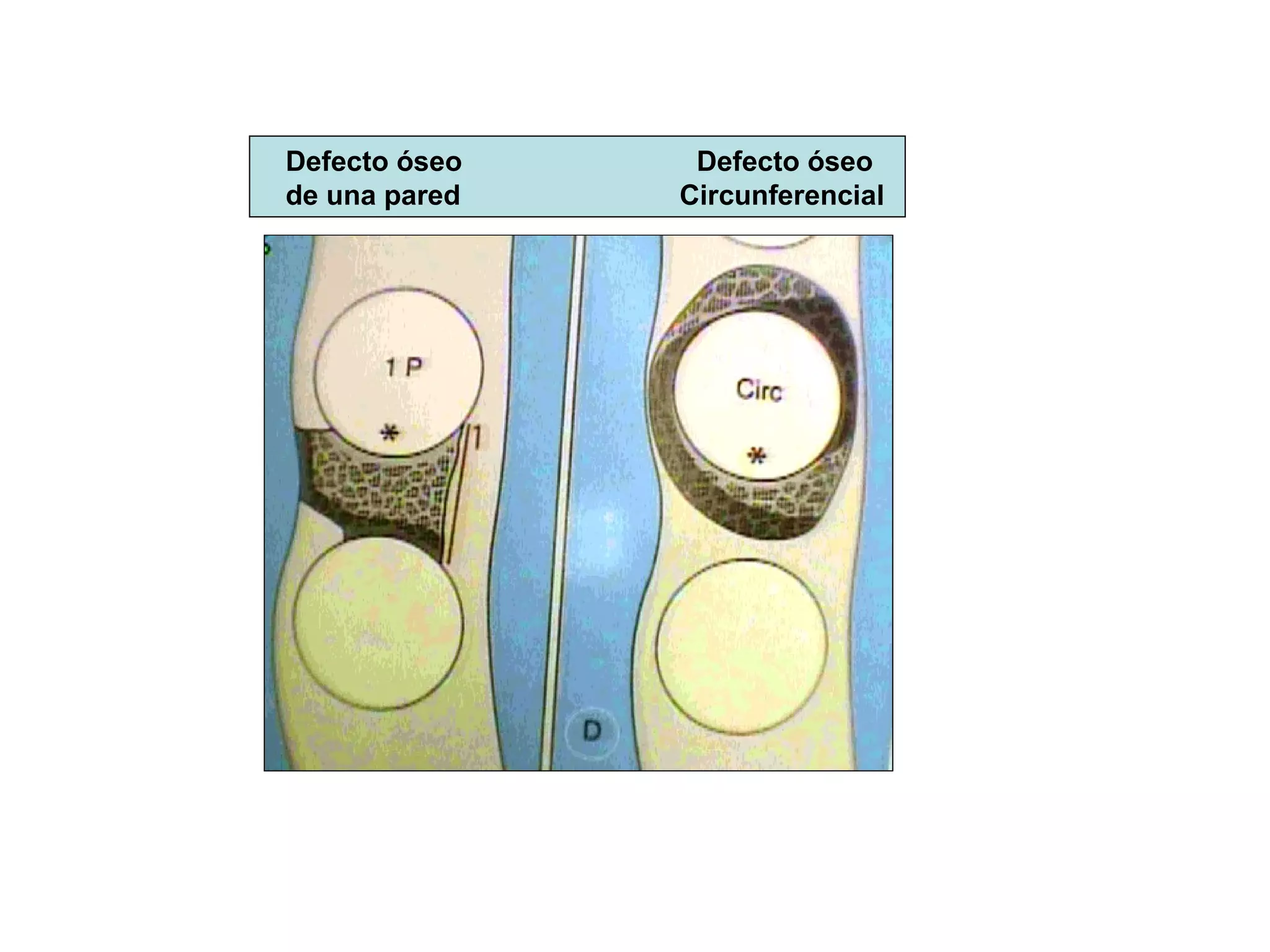 Furcas y defectos oseos | PPT | Dental Health | Diseases and Conditions