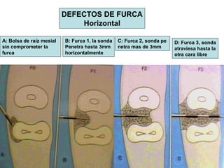 Furcas y defectos oseos | PPT