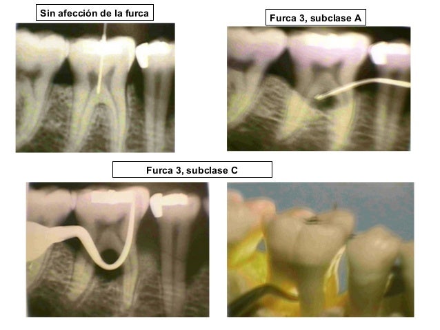 Furcas y defectos oseos