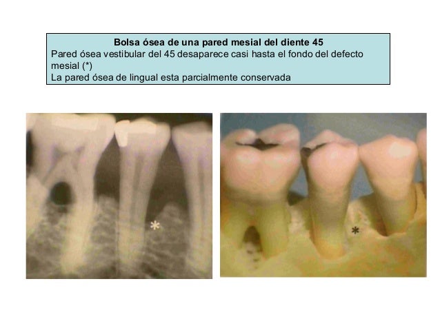 Furcas y defectos oseos