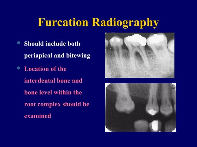 Furcation | PPT