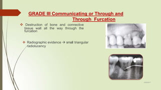 Furcation | PPTX