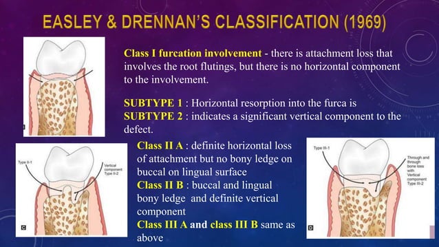Furcation involvement and management | PPTX | Bone and Joint Conditions ...