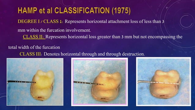 Furcation involvement and management | PPTX | Bone and Joint Conditions ...