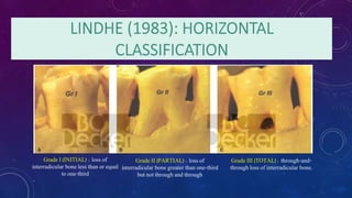 Furcation involvement and management | PPTX