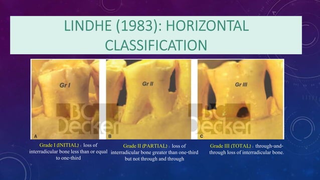 Furcation involvement and management | PPTX | Bone and Joint Conditions ...