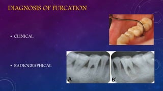 Furcation involvement and management | PPTX