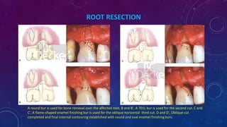 Furcation involvement and management | PPTX