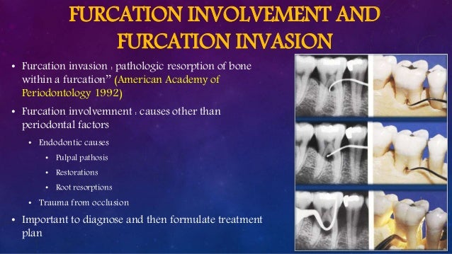 Furcation involvement and management