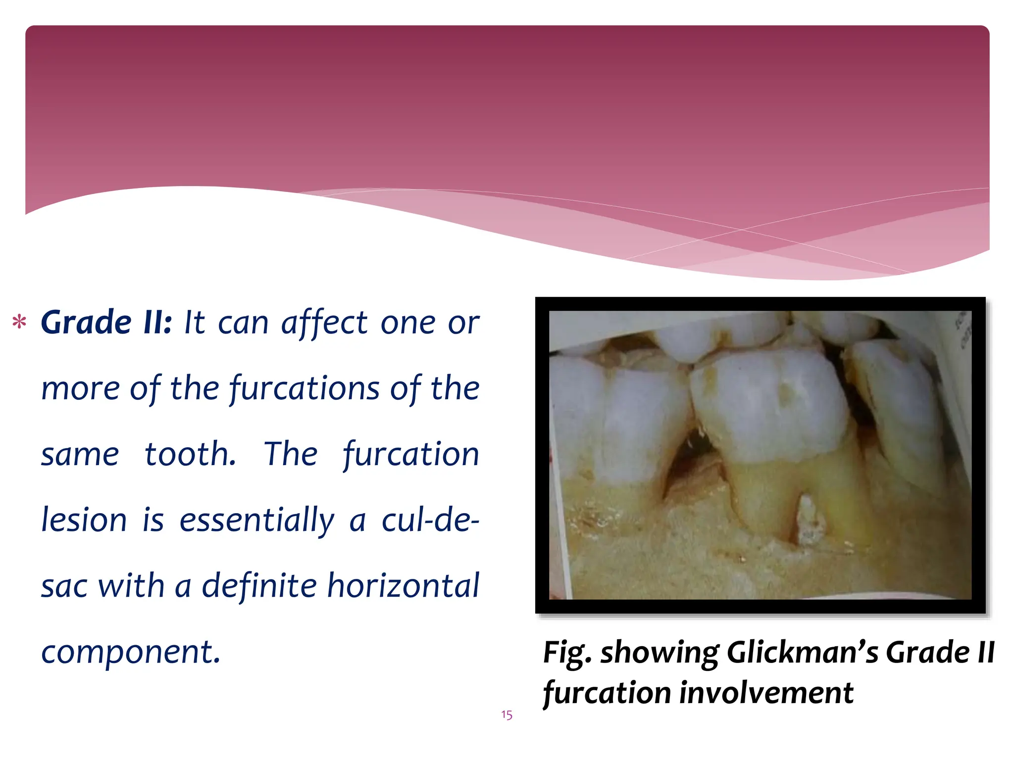 FURCATION and its classification 1 .pptx