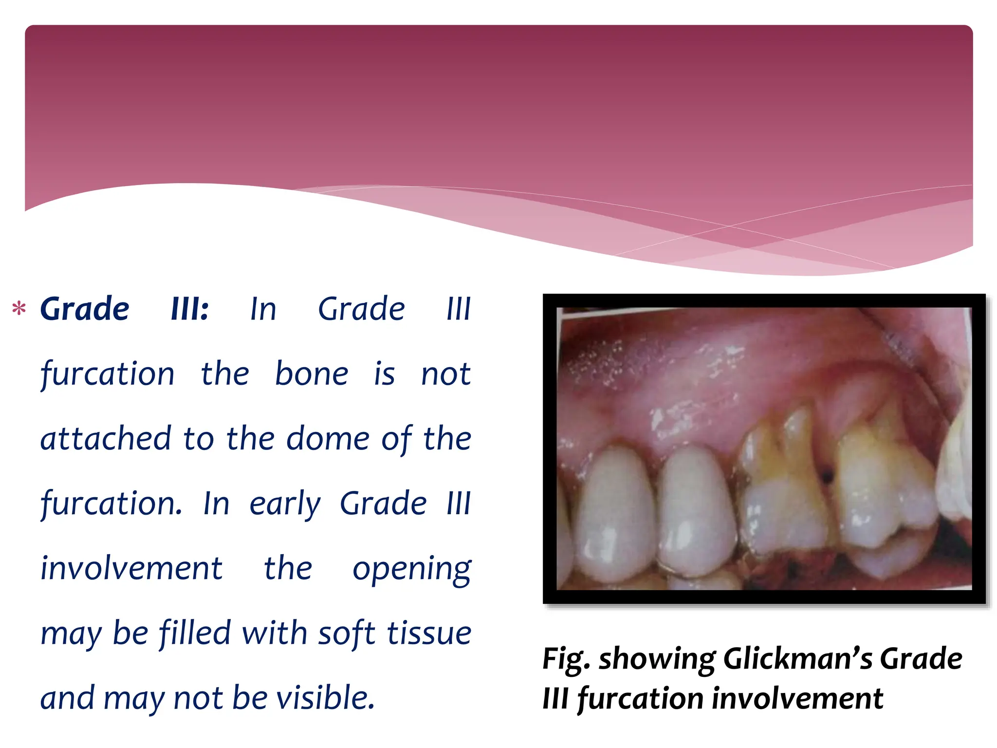 FURCATION and its classification 1 .pptx
