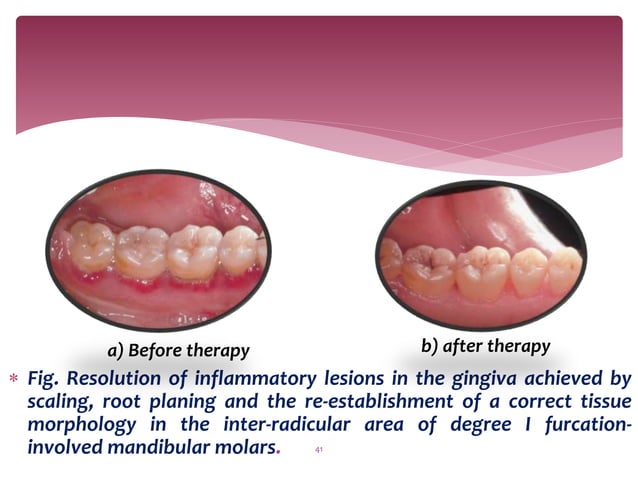 FURCATION and its classification 1 .pptx