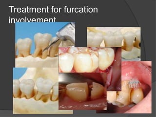 Furcation case | PPT