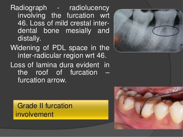 Furcation case