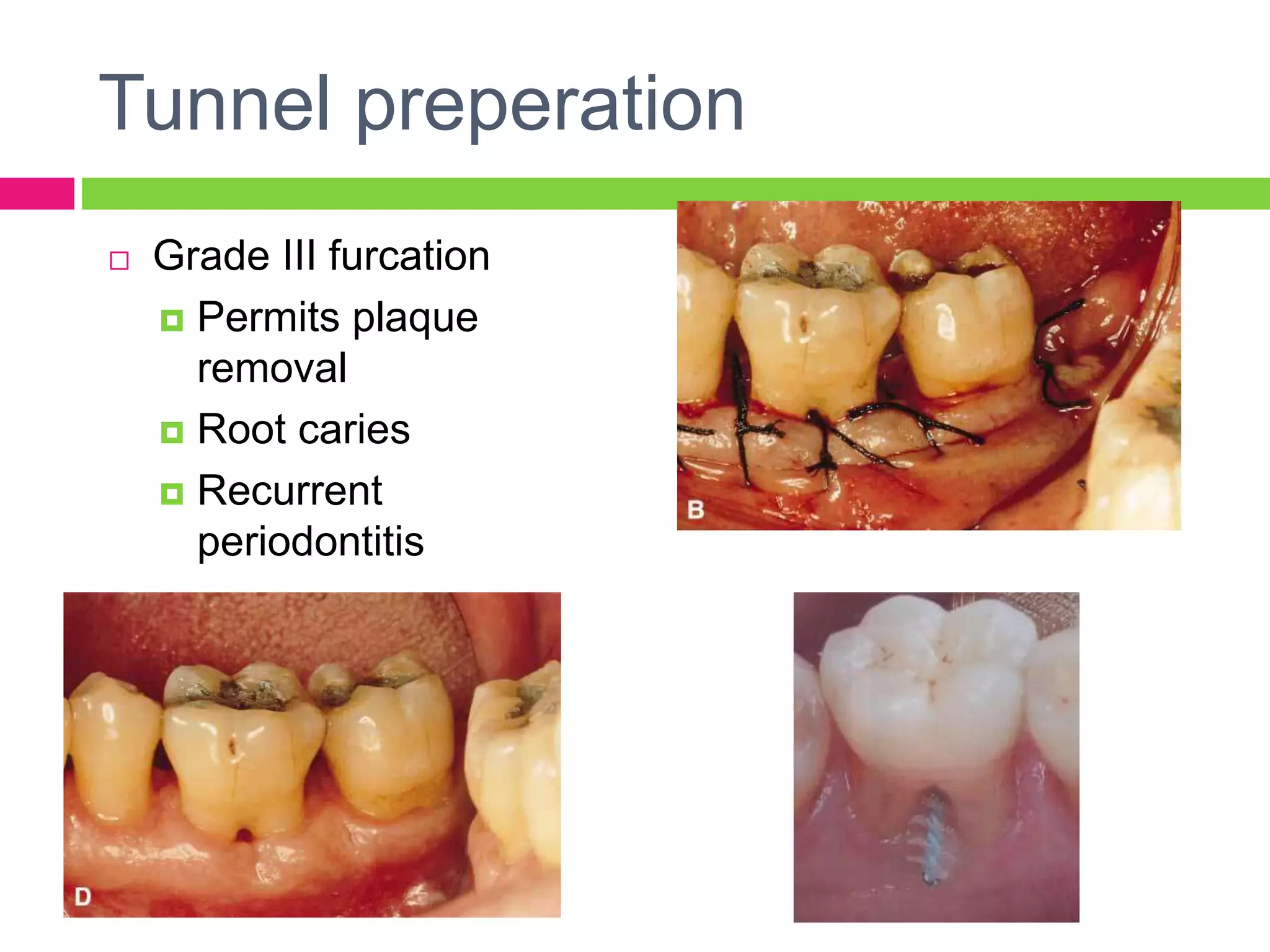 Furcation involvement | PPTX