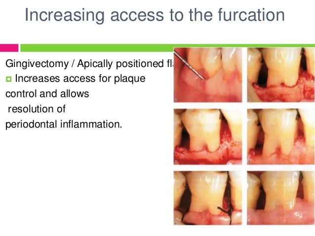 Furcation involvement