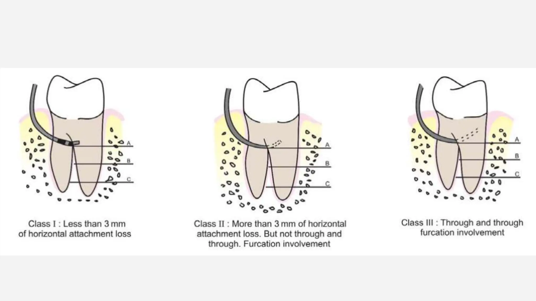 Furcation involvement-periodontology-2.pptx