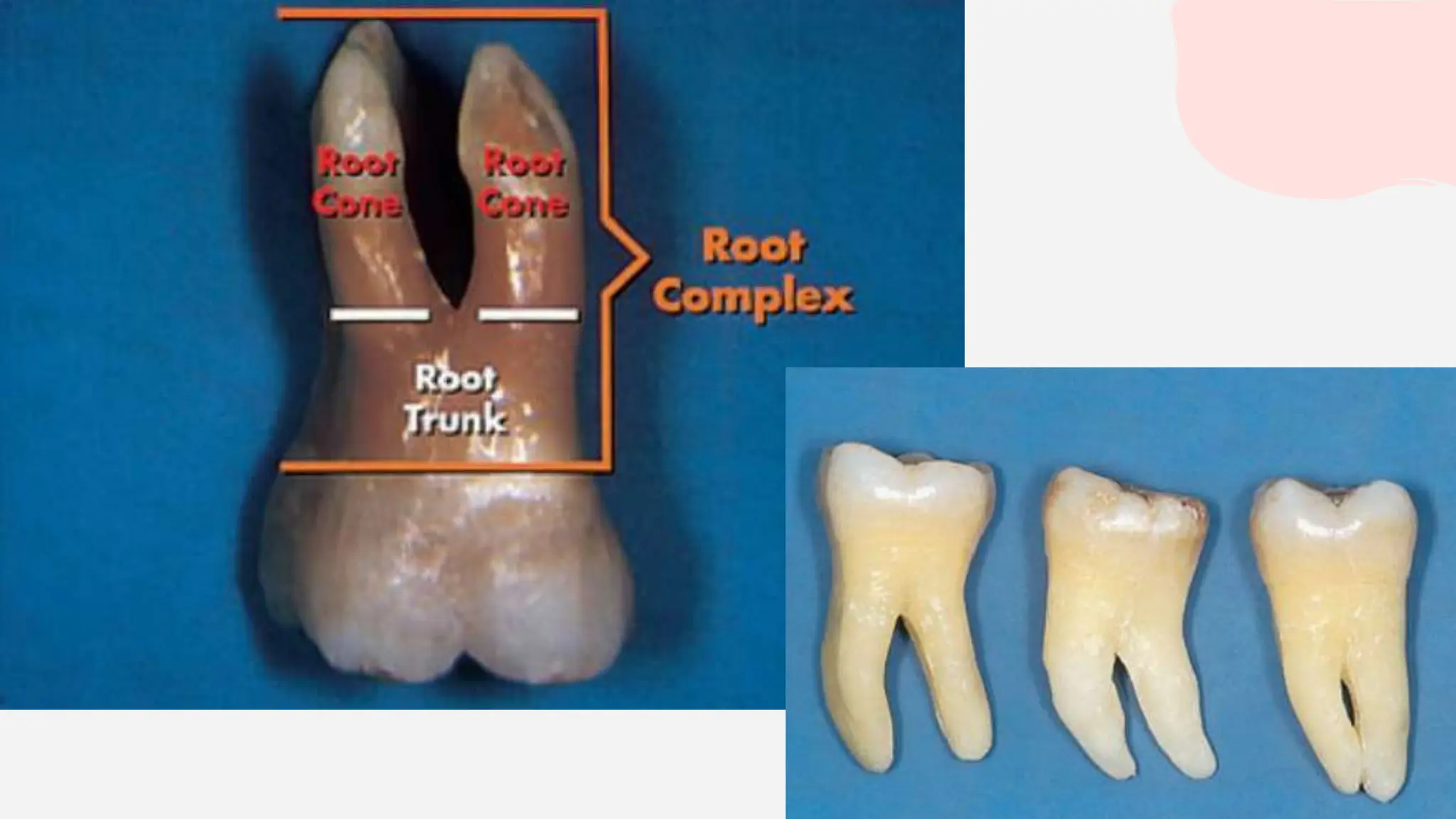 Furcation involvement-periodontology-2.pptx