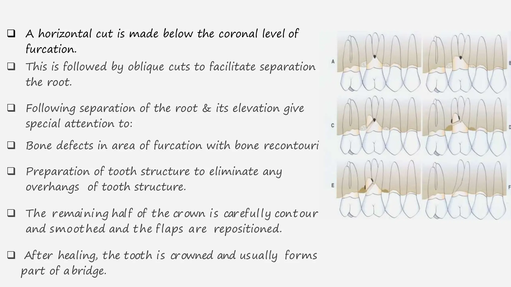 Furcation involvement-periodontology-2.pptx