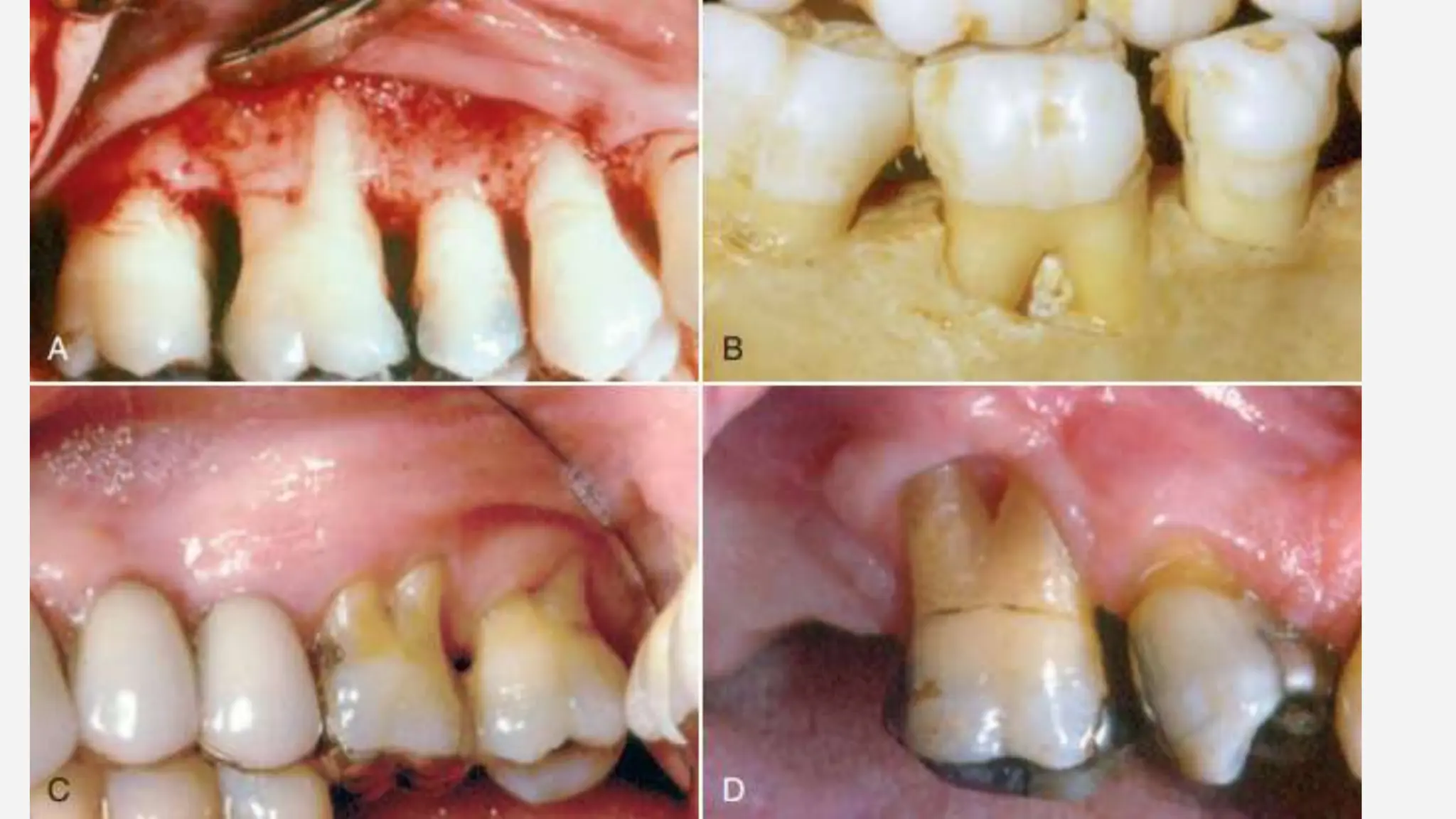 Furcation involvement-periodontology-2.pptx